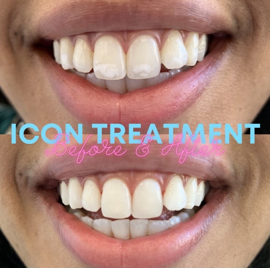 Icon Spot Treatment - Galloro Dental Group