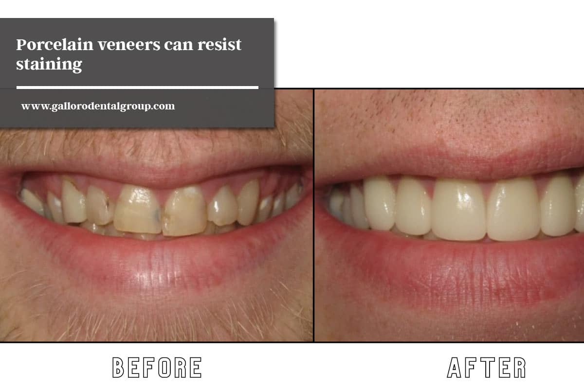 What You Need to Know Before Getting Porcelain Veneers - Galloro Dental ...