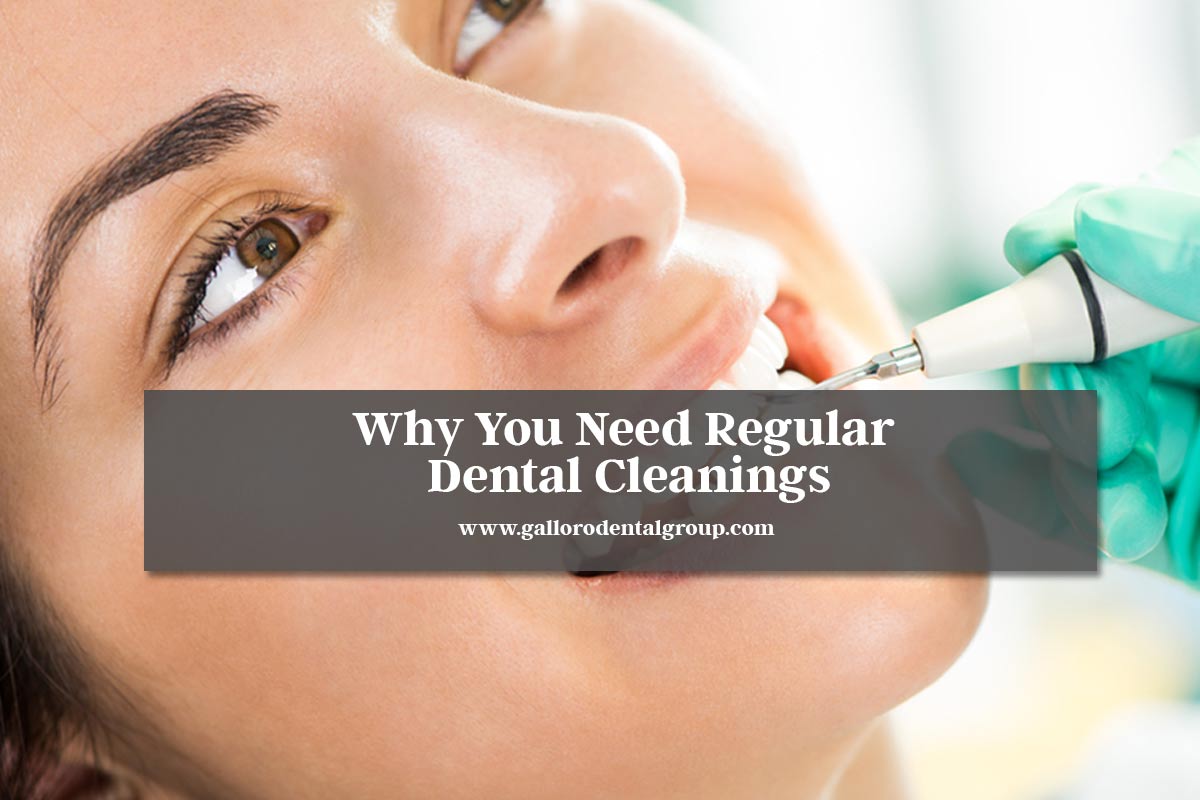 Why You Need Regular Dental Cleanings - Galloro Dental Group